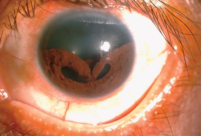 An Odd Eye Injury Caused a Man's Iris to 'Collapse' | Live Science