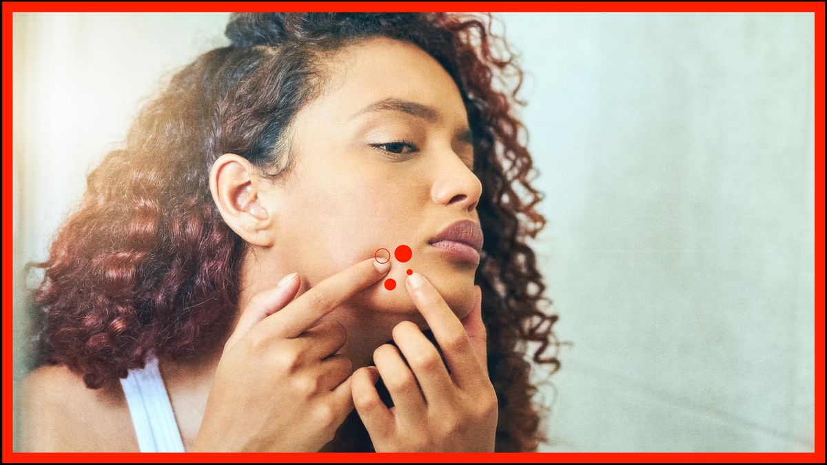 The 4 Types of Acne and How to Treat Each (With Pictures) | Marie Claire