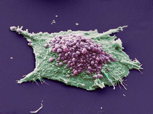 Cancer Is a Man-Made Disease, Controversial Study Claims | Live Science
