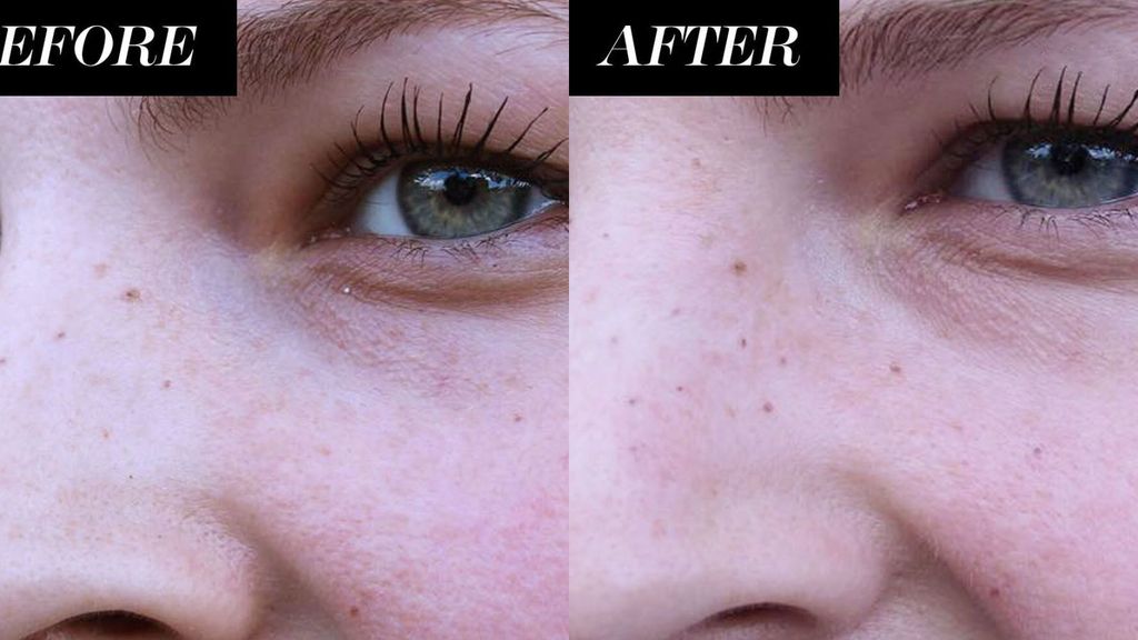 Freckle Tattoos - Permanent Freckle Treatment | Marie Claire