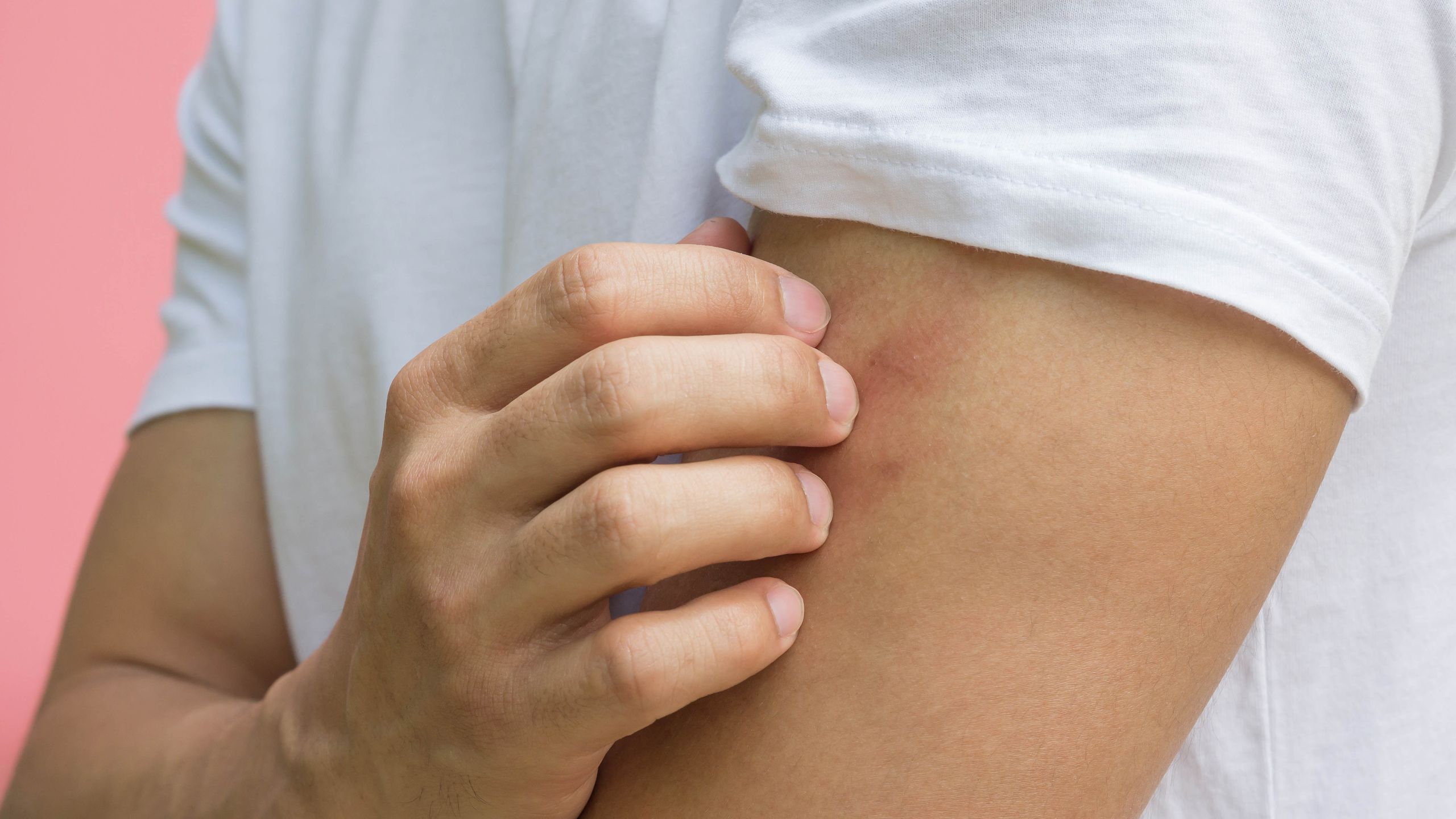 Mystery bites? How to identify what's really biting you | Tom's Guide