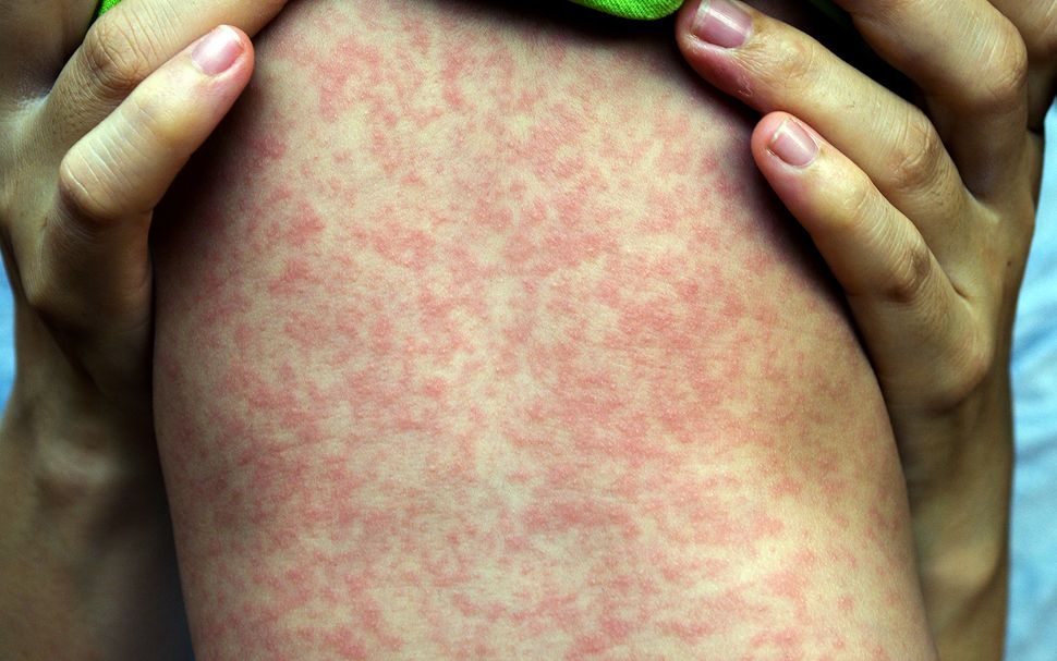 This One Number Shows Why Measles Spreads Like Wildfire | Live Science
