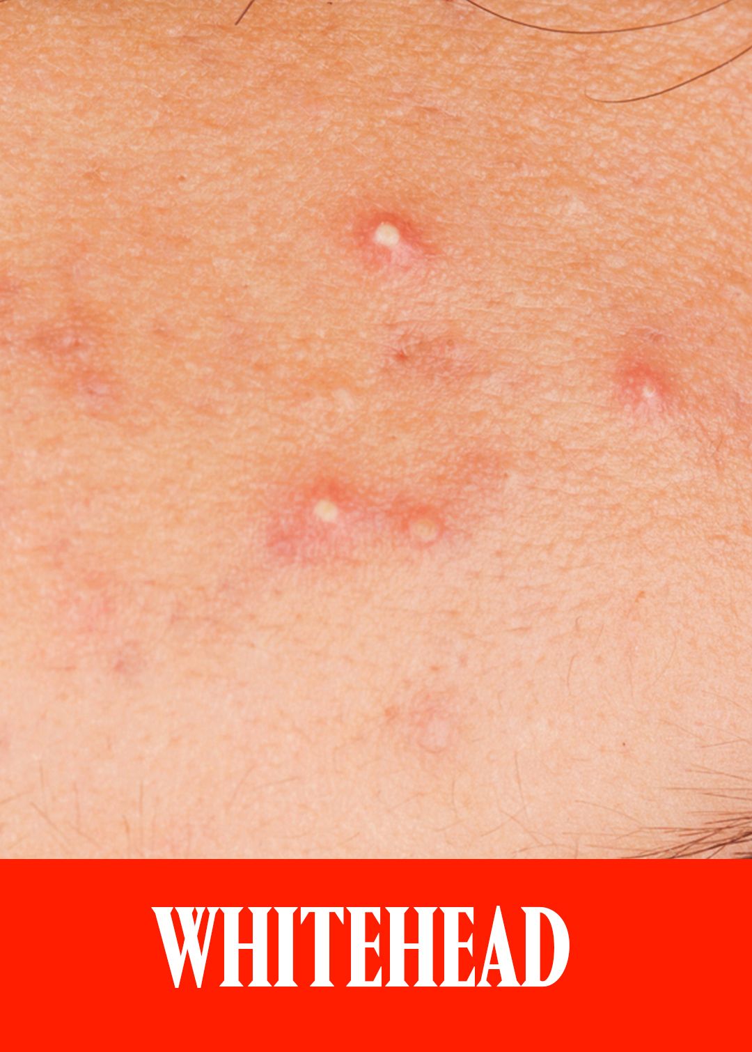 The 4 Types of Acne and How to Treat Each (With Pictures) | Marie Claire