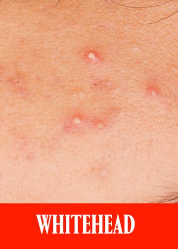 The 4 Types of Acne and How to Treat Each (With Pictures) | Marie Claire