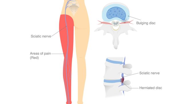 Doctor says these are the 3 core exercises you need to relieve sciatica symptoms and boost ab ...