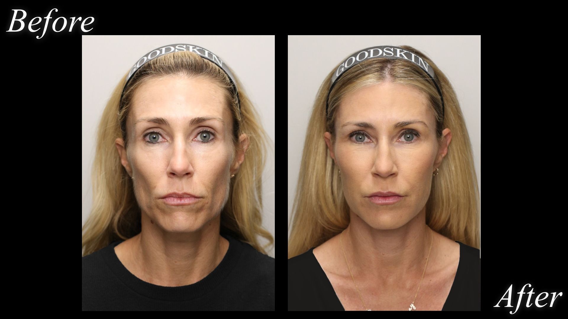 Is Fat Grafting the New Filler? Plastic Surgeons Explain | Marie Claire