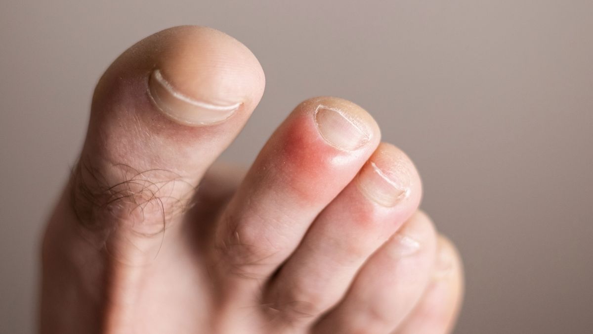 The curse of winter chilblains – and how to avoid them if you spend ...