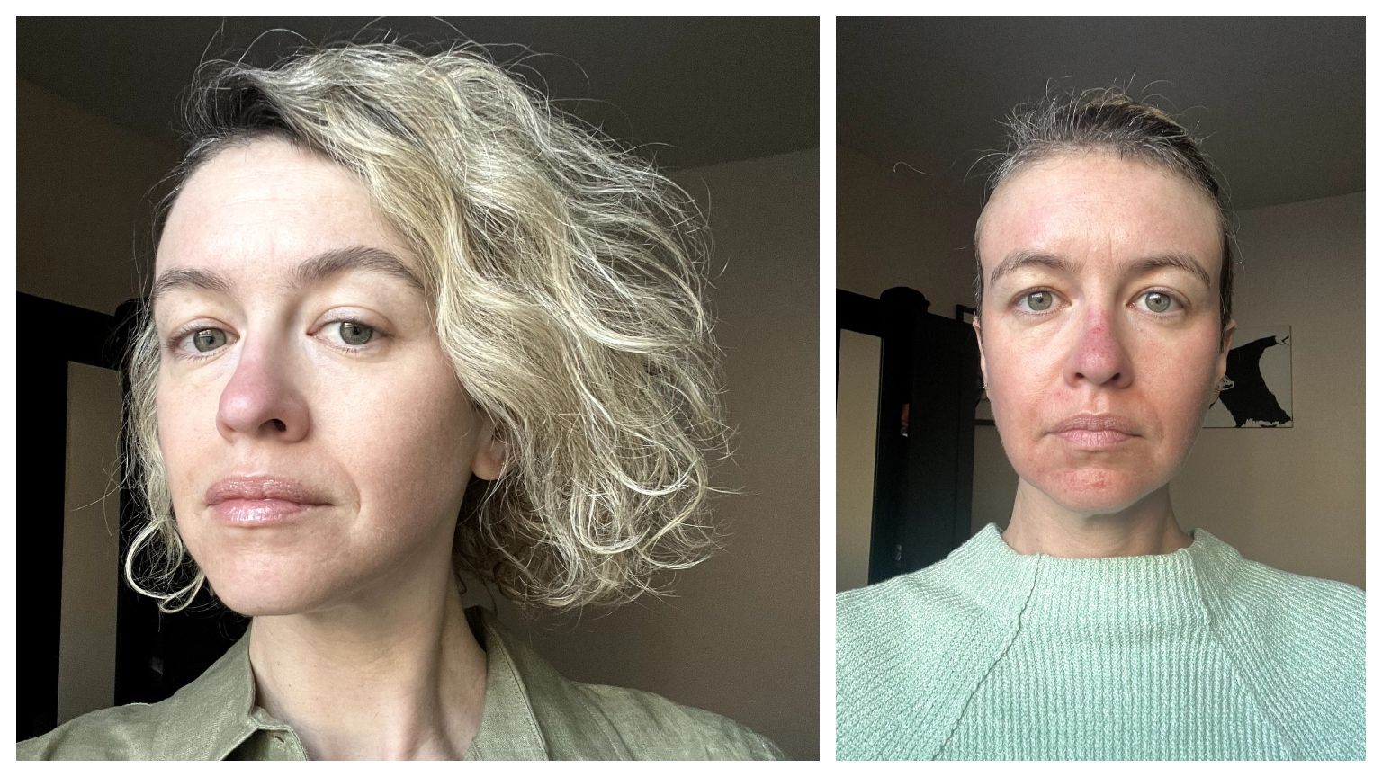 Laser Stacking for Better Skin: I Tried BBL and Halo Treatments | Marie ...