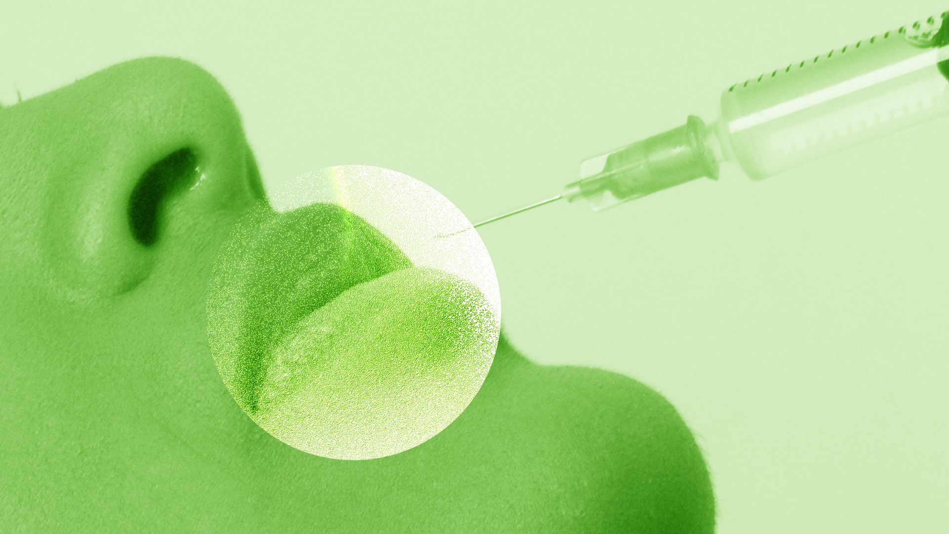I Dissolved My Lip Filler: Pain, How it Works, and Photos | Marie Claire