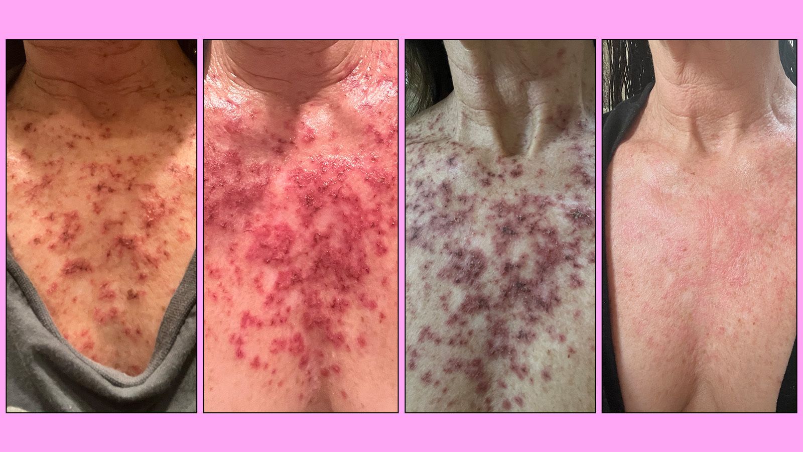 Efudex Cream Removed Years of My Sun Damage: Review | Marie Claire