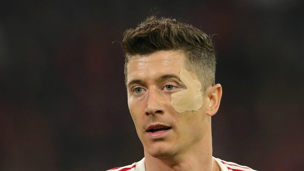 Lewandowski shows off black eye from Champions League clash | FourFourTwo