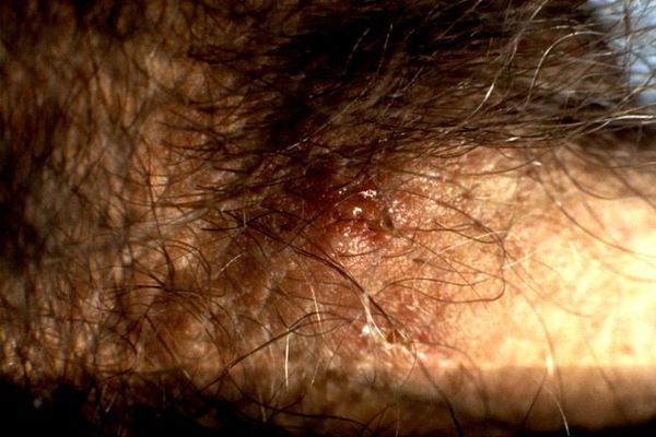 Herpes Pictures & Symptoms of Herpes Simplex | Live Science