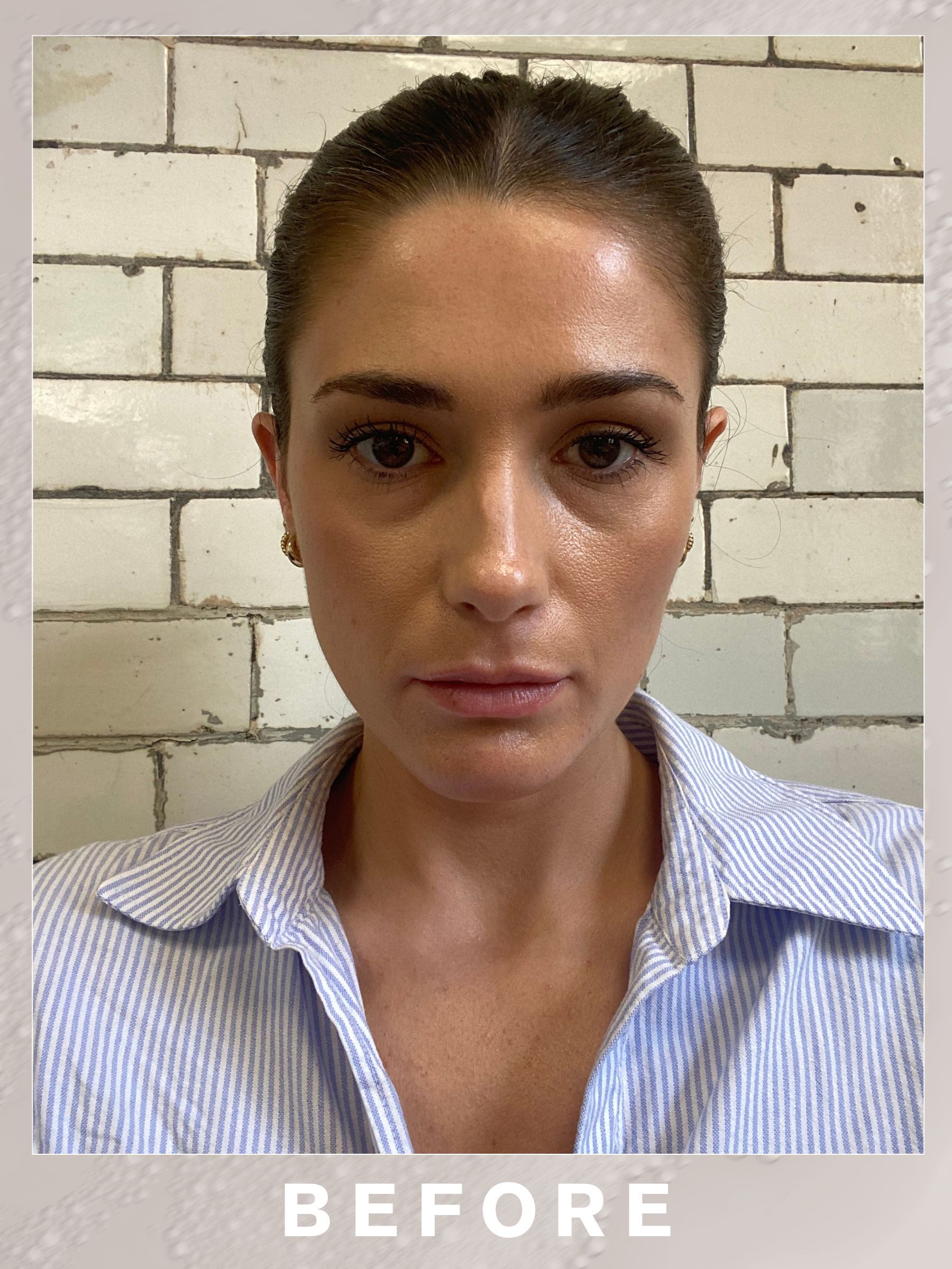I Got Botox for the First Time—Here's What You Should Know | Who What Wear