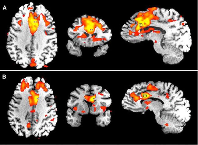 Human Perseverance Linked to Brain Region | Live Science