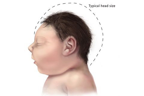 Microcephaly: Causes & Symptoms | Live Science