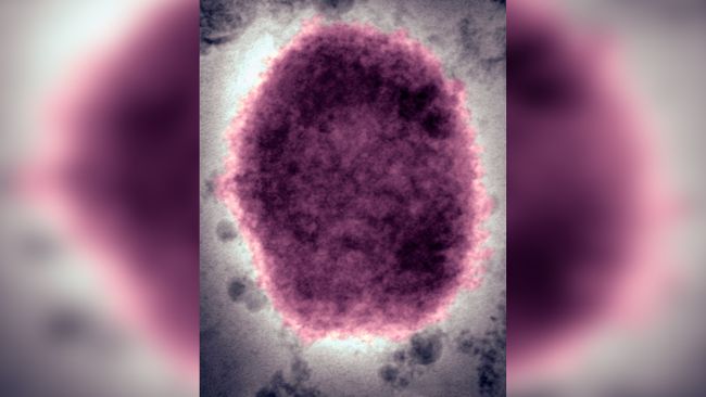 Mpox (monkeypox): Symptoms, pictures, treatments & vaccines | Live Science