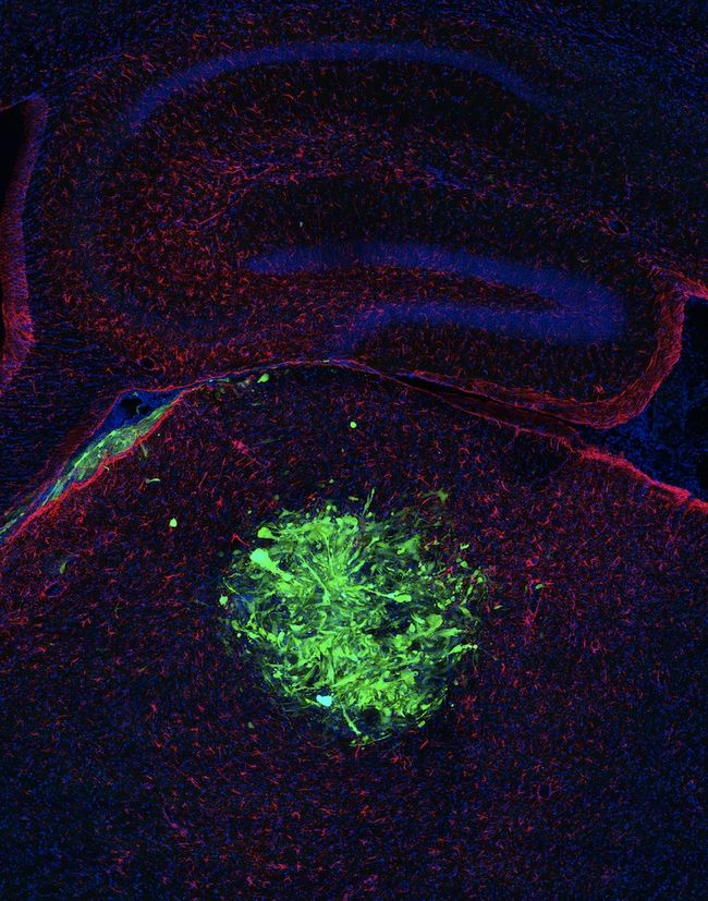Colorful But Deadly: Images of Brain Cancer | Live Science