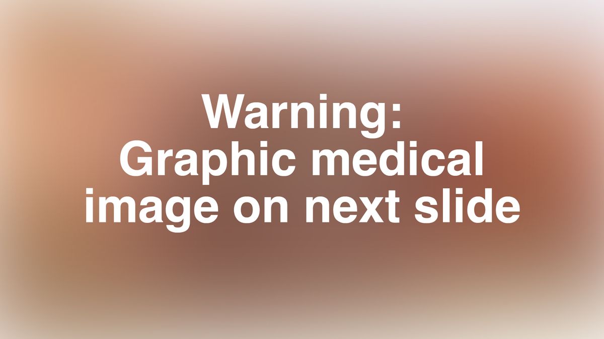 Necrotizing fasciitis: The 'flesh-eating' infection that bores holes in the body | Live Science