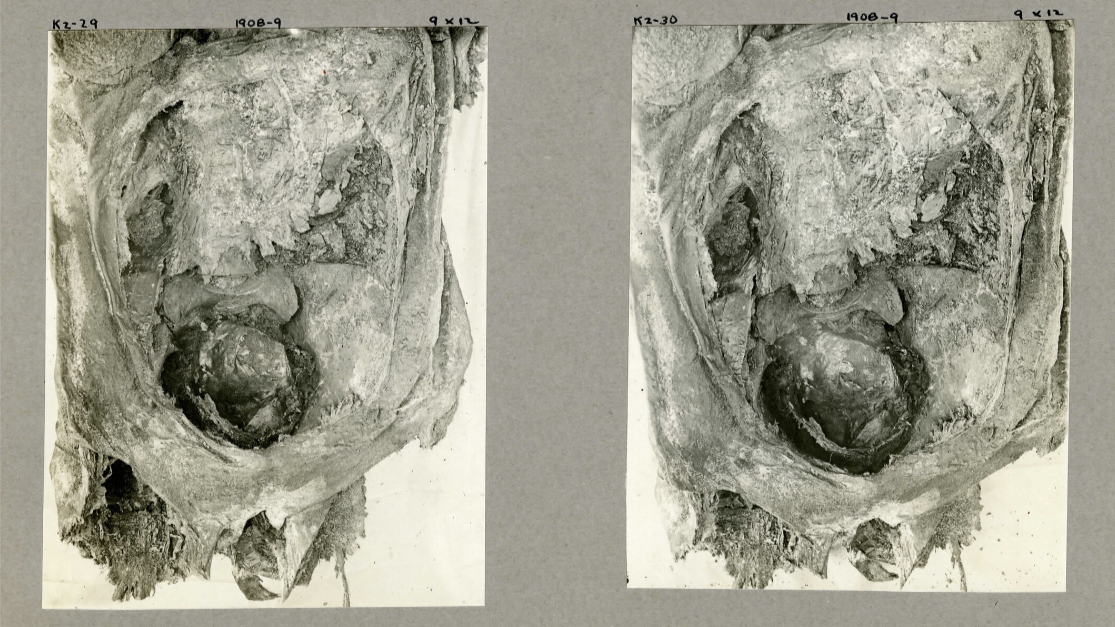 Ancient Egyptian teenager died while giving birth to twins, mummy ...