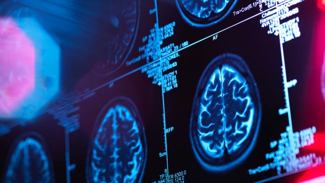 Type 3 diabetes: Symptoms, causes and treatments | Live Science