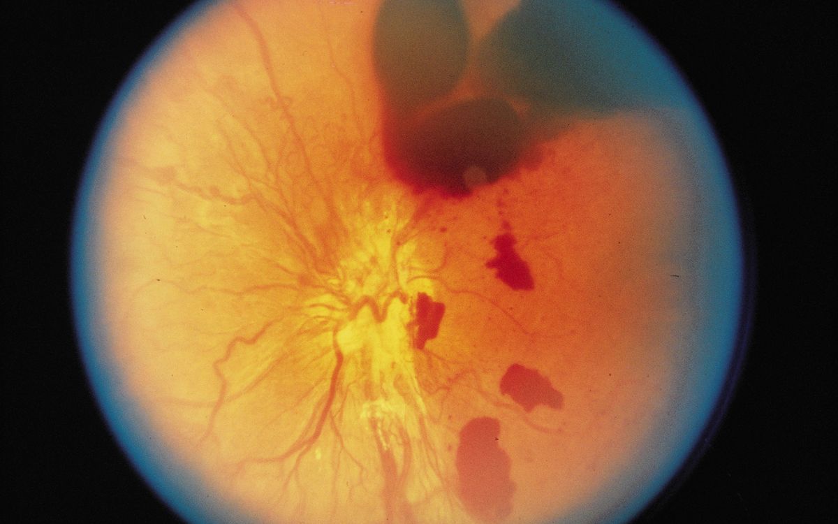 A Chiropractor Adjusted Her Neck. Then This Woman's Vision Problems ...