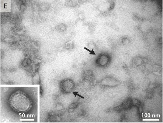 New Virus Infecting People in China, and Ticks May Be the Culprit ...