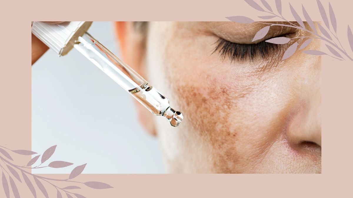 Hyperpigmentation vs melasma: How to tell the difference between these ...