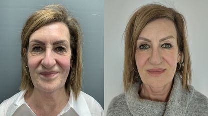 An honest Profhilo review with before and after pictures | Woman & Home