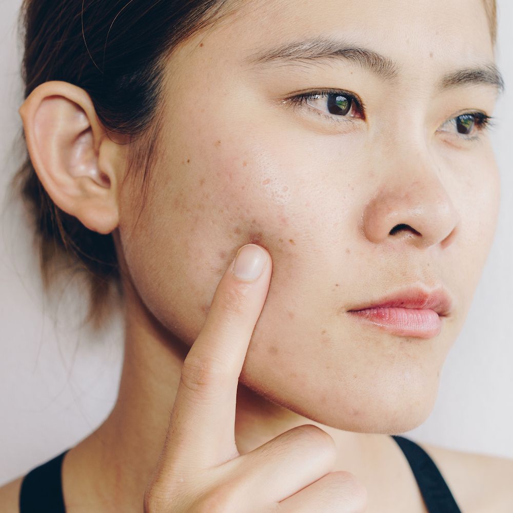 Acne on cheeks: the expert-led guide to managing it | Marie Claire UK
