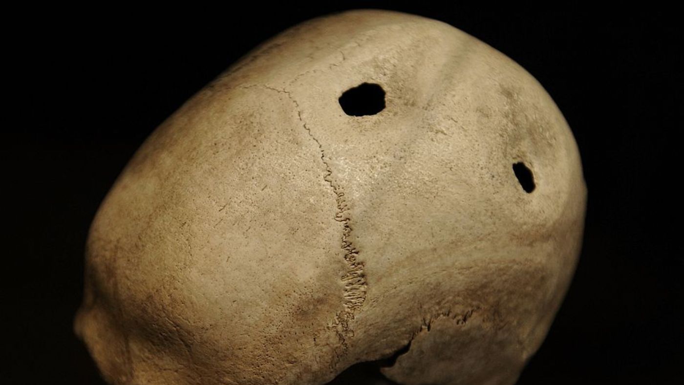 Rare brain surgery performed 3,500 years ago | The Week