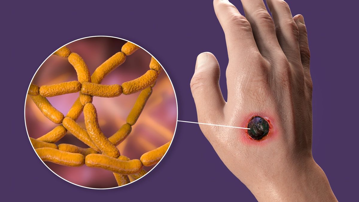 Anthrax has killed over 50 animals in Wyoming — what's the risk to ...