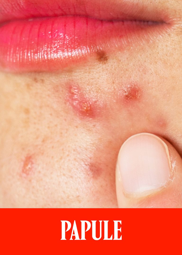 The 4 Types of Acne and How to Treat Each (With Pictures) | Marie Claire