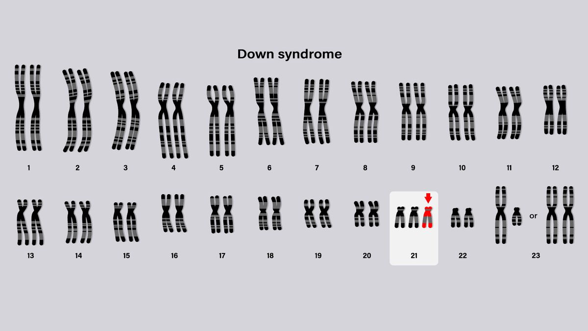 What is Down syndrome? | Live Science