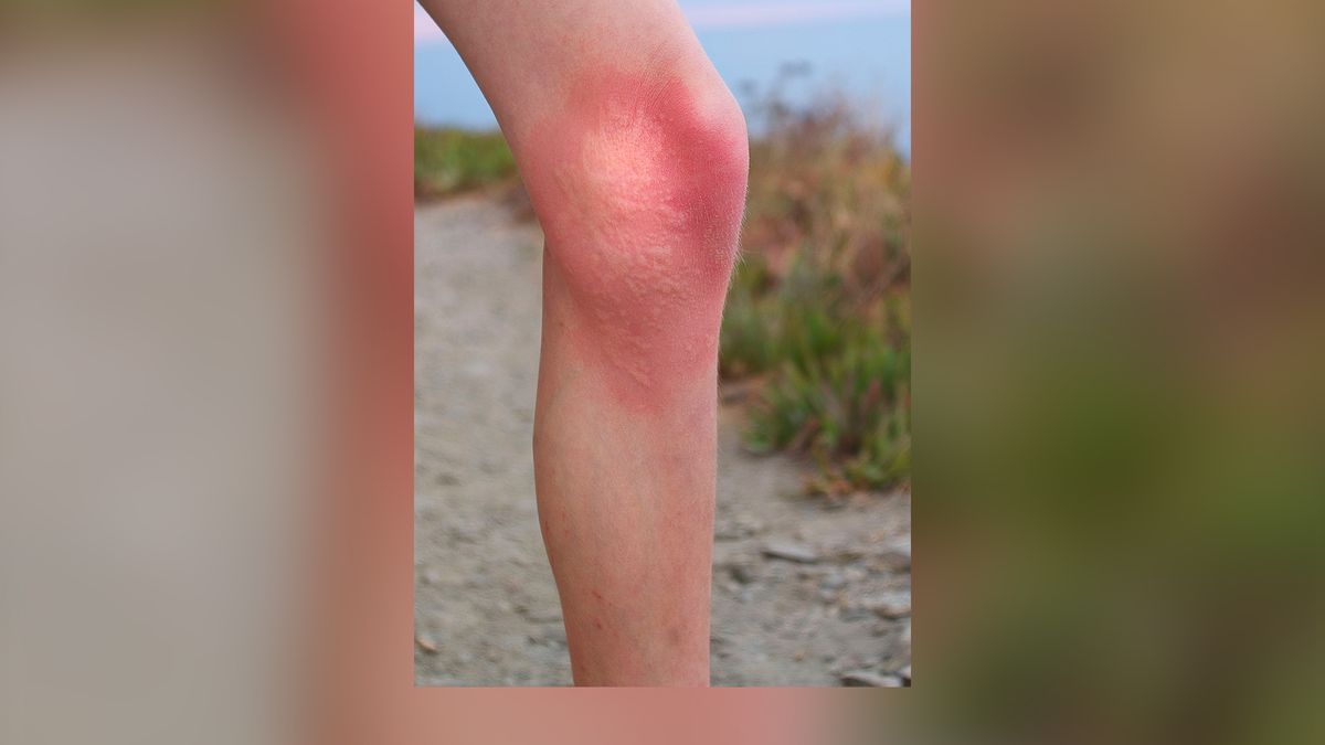 Should you really pee on a jellyfish sting? | Live Science