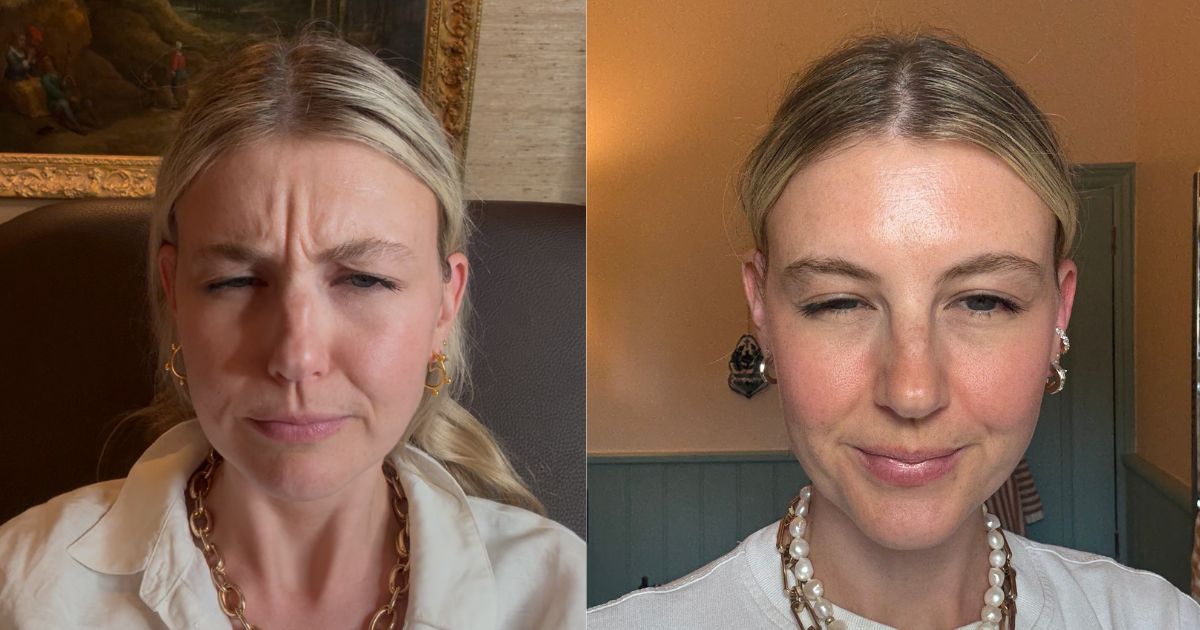 I'm 37 and Just Got Botox For The First Time—This Is What I Wish I'd ...