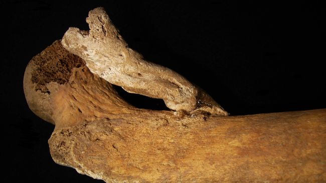 Centuries-old skeleton with massive, crippling bone growth unearthed in ...