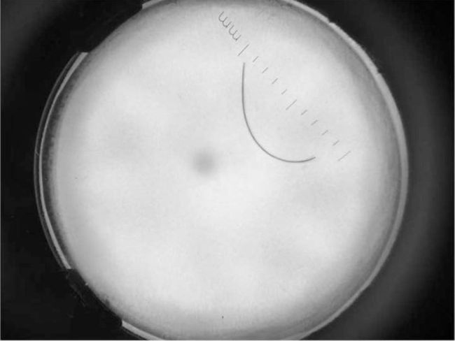 Man's Foot Pain Was Due to Rare 'Hair Splinter' | Live Science