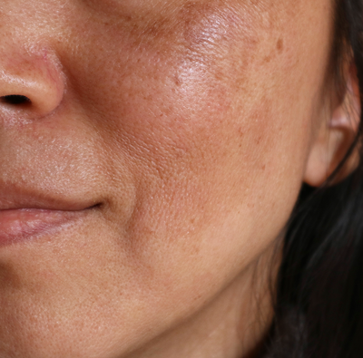 Exactly How to Treat Melasma, According to Dermatologists | Marie Claire