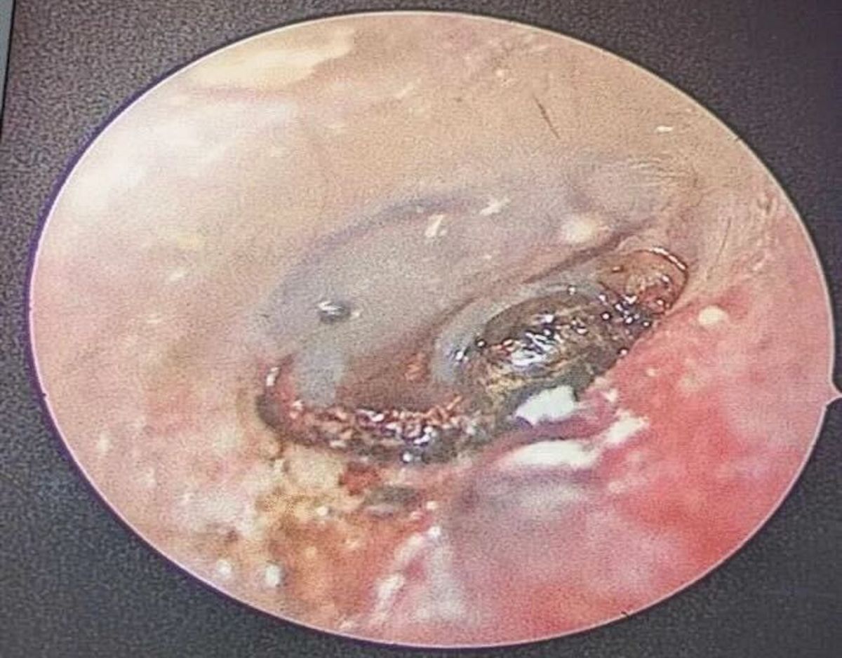 Woman's sudden hearing loss turned out to be a tick lodged in her ear ...