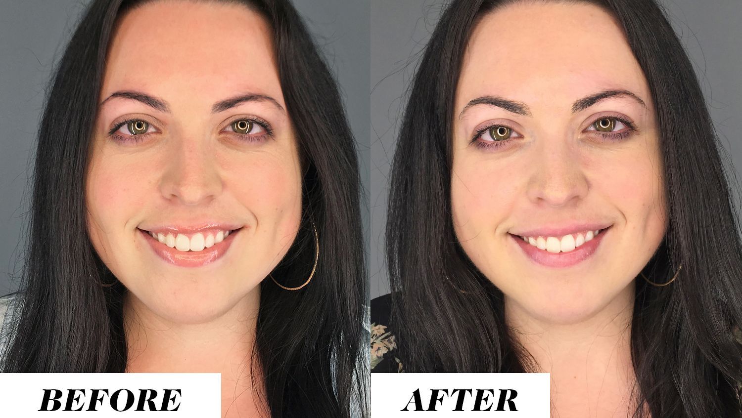 Does Drinking Water Help Your Skin - Facts on Drinking Water for Acne ...