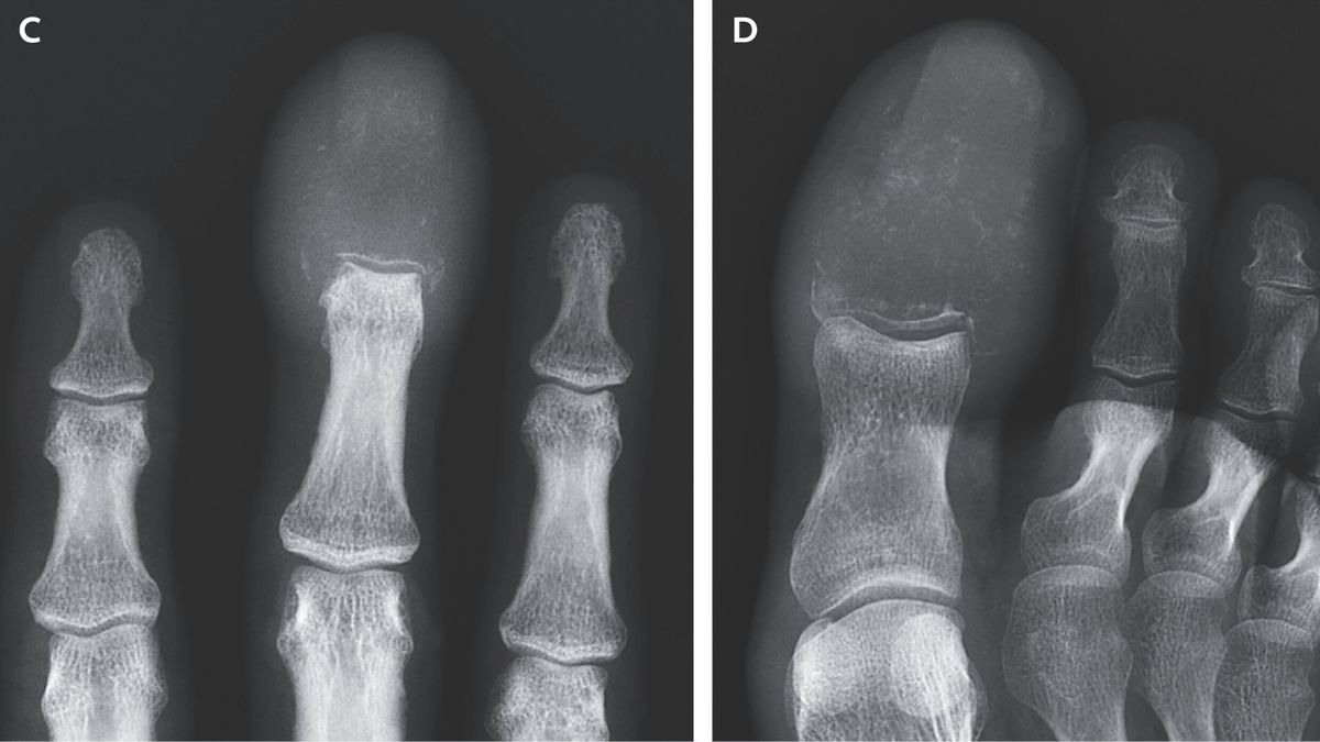 Weird swelling of man's fingers and toes revealed cancer had ...