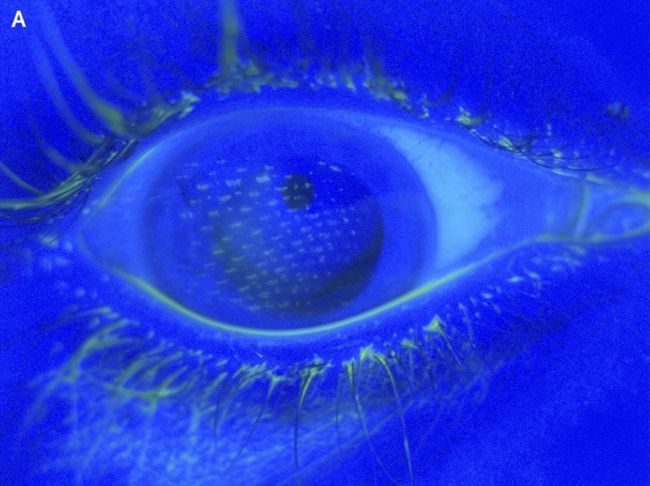 'Eye' Can't Look: 9 Eyeball Injuries That Will Make You Squirm | Live ...