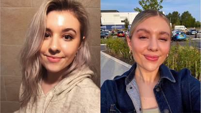 Dissolving Filler: What Experts Want You To Know | Marie Claire UK