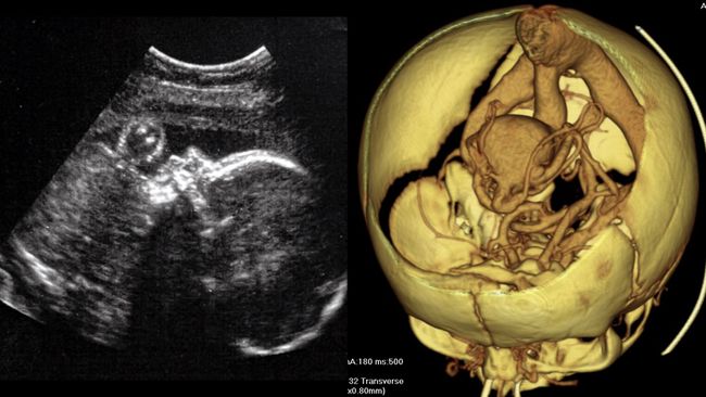 Doctors perform 1st-of-its-kind brain surgery on a fetus in the womb ...
