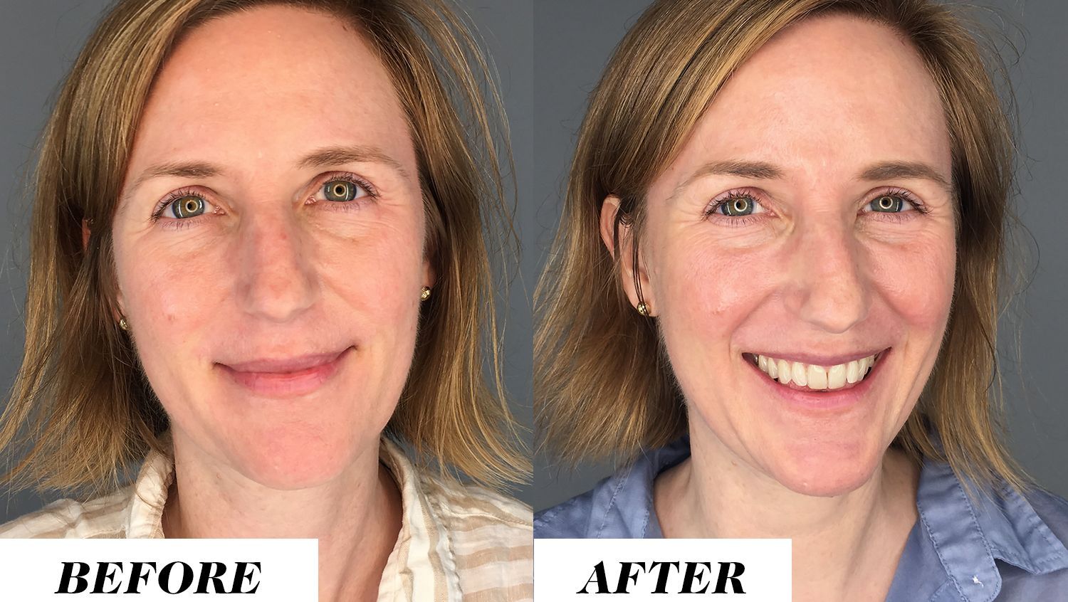 Does Drinking Water Help Your Skin - Facts on Drinking Water for Acne ...