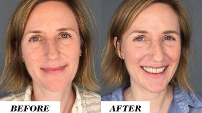 Does Drinking Water Help Your Skin - Facts on Drinking Water for Acne ...