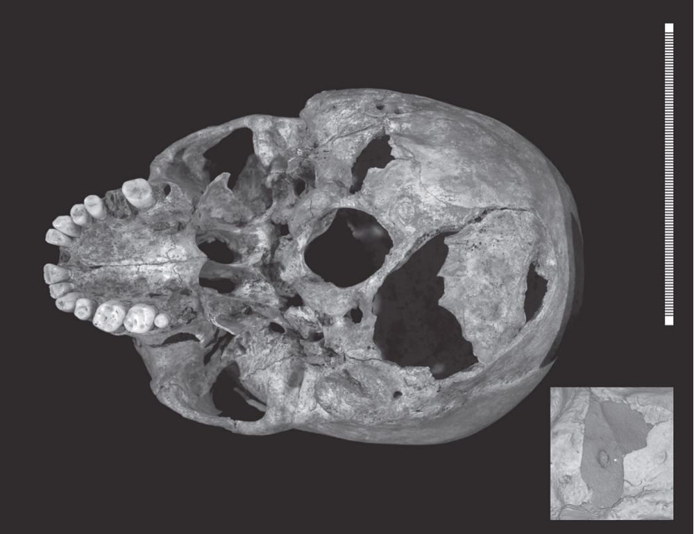 Postmortem Photos: King Richard III's Battle Injuries | Live Science