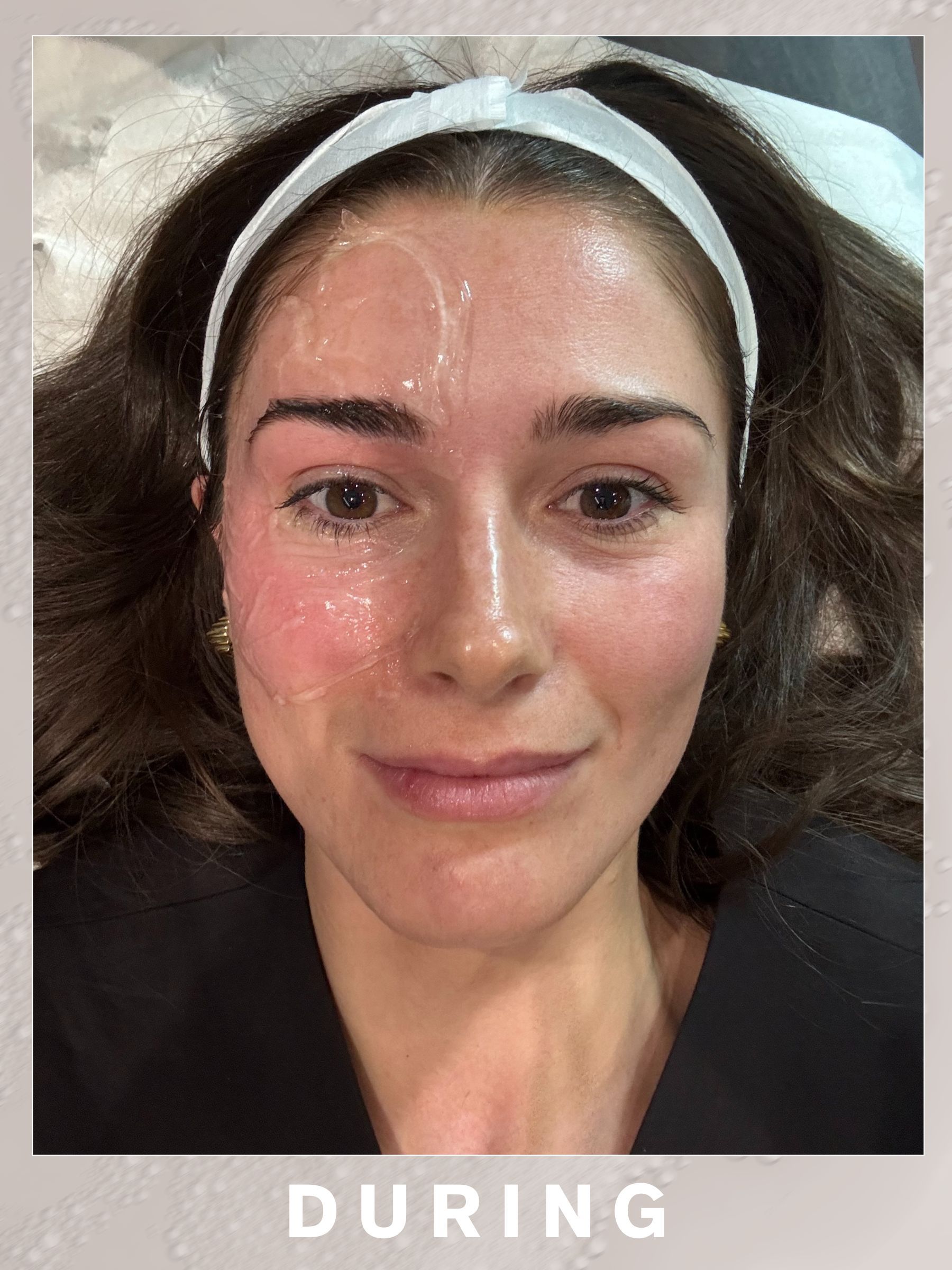 Sofwave Brow Lift Reviewed by a Beauty Editor | Who What Wear