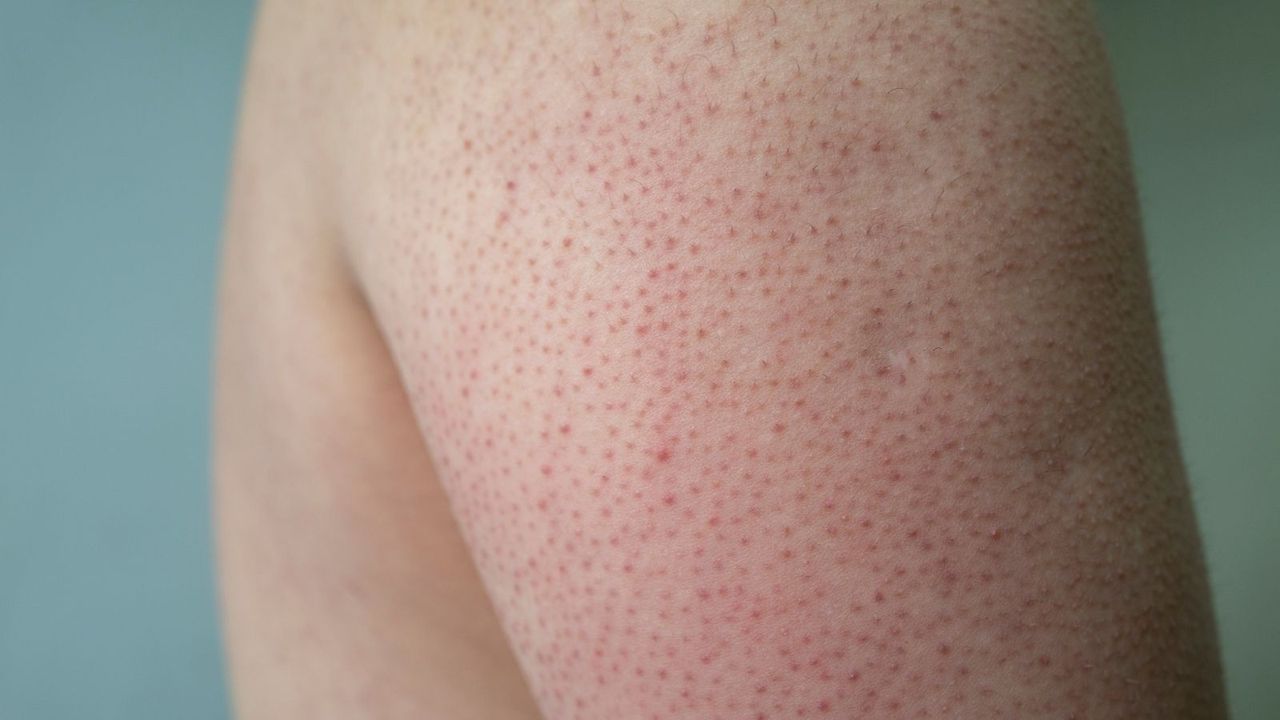 How to fix chicken skin—treat keratosis pilaris for good | Woman & Home