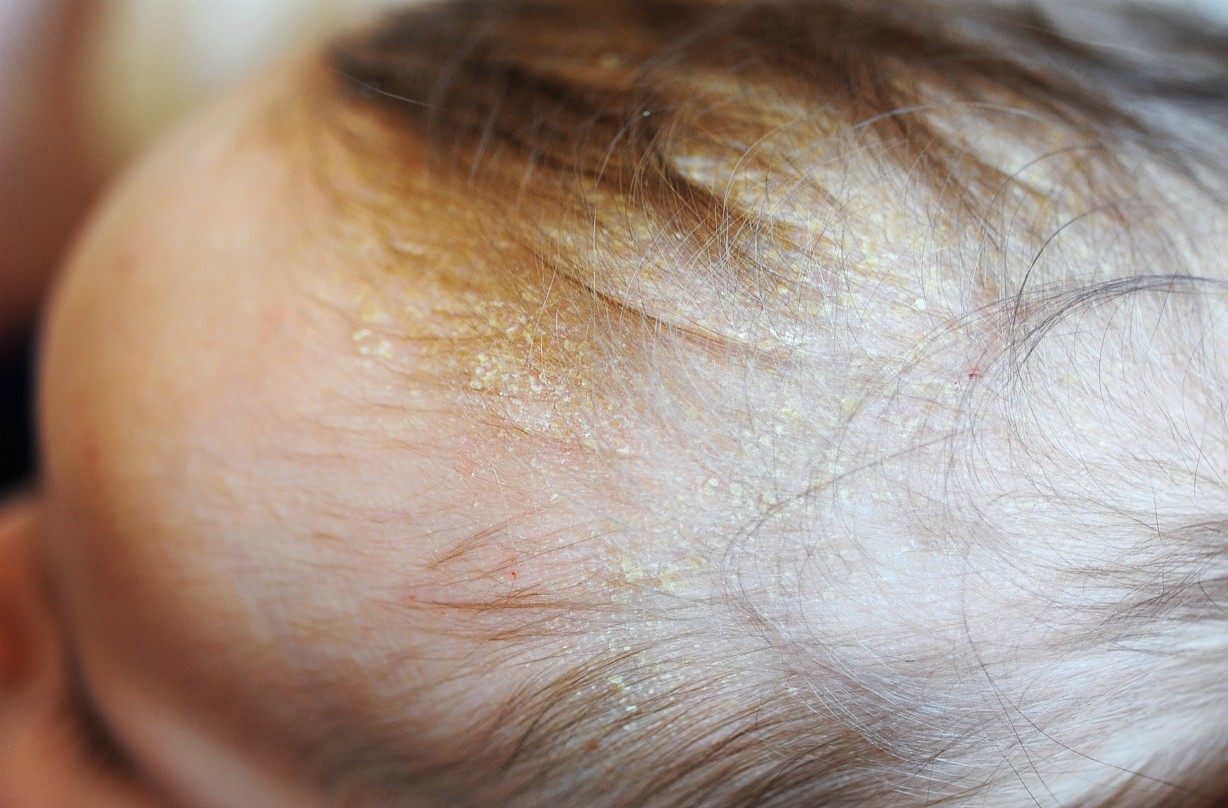 Ringworm: What is ringworm and how do you get it? | GoodTo